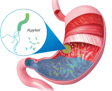 H. Pylori Urea Breath Test Supplier & Manufacturer | Headway